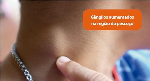 Ganglios_aumentados_no_pescoço - Abrale